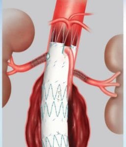 Houston Vascular Surgeon for EVAR | AAA Treatment