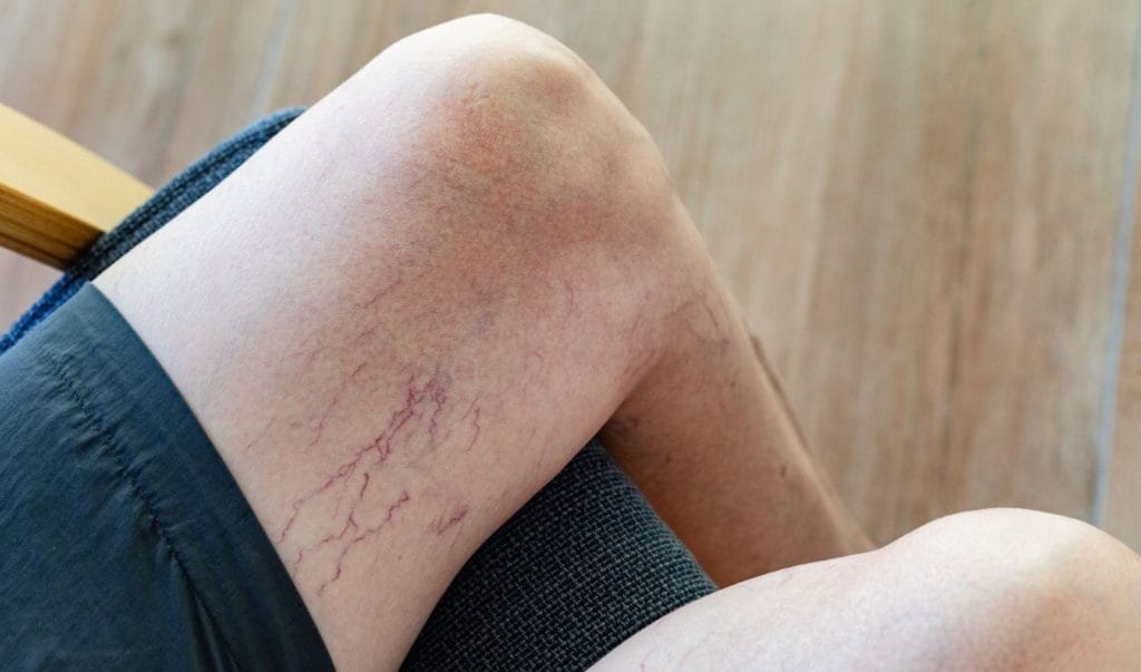 Can Varicose Vein Treatment Cause a Blood Clot? - Rema Malik MD